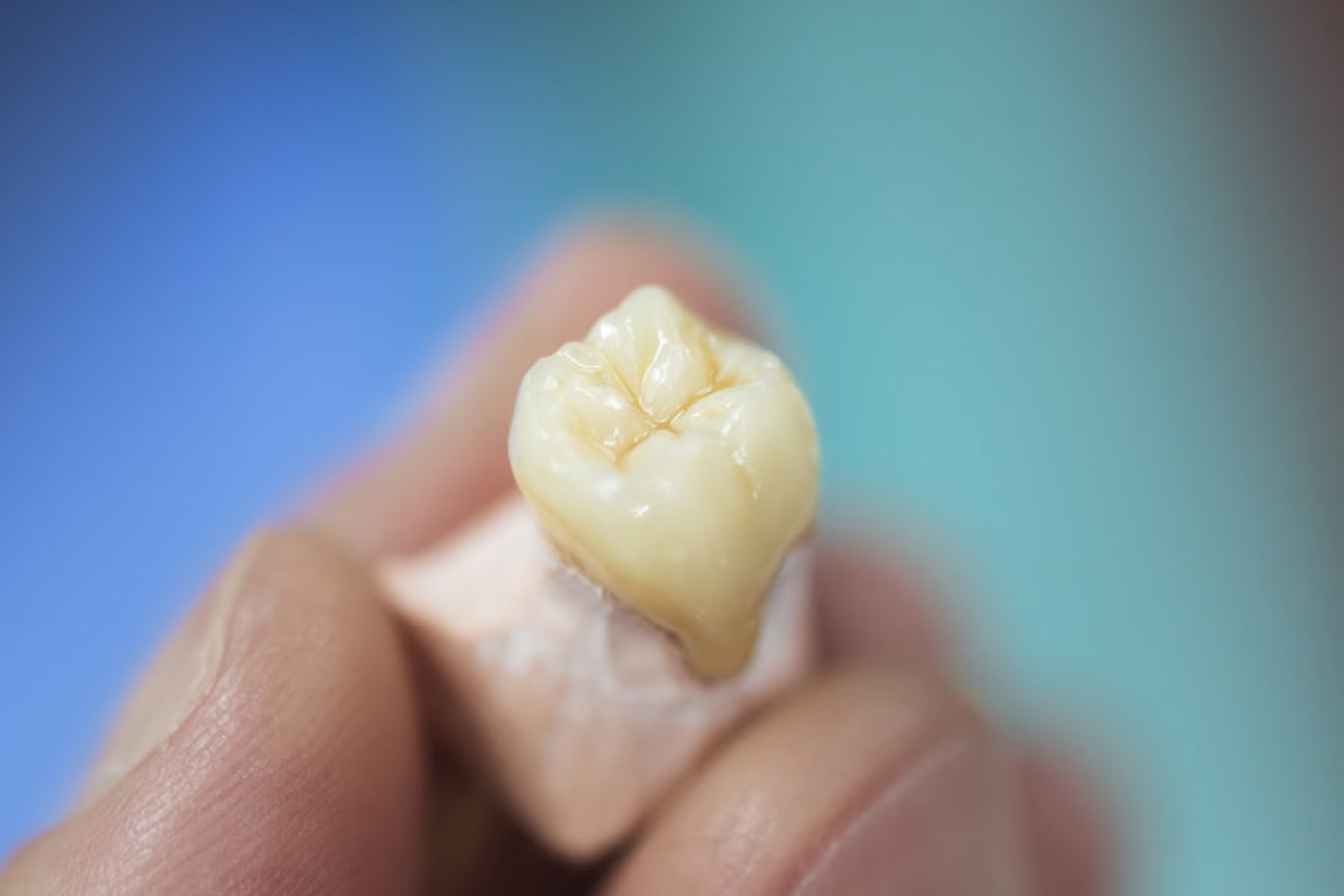 Model-Less Crowns - Confident Dental Lab Minnesota